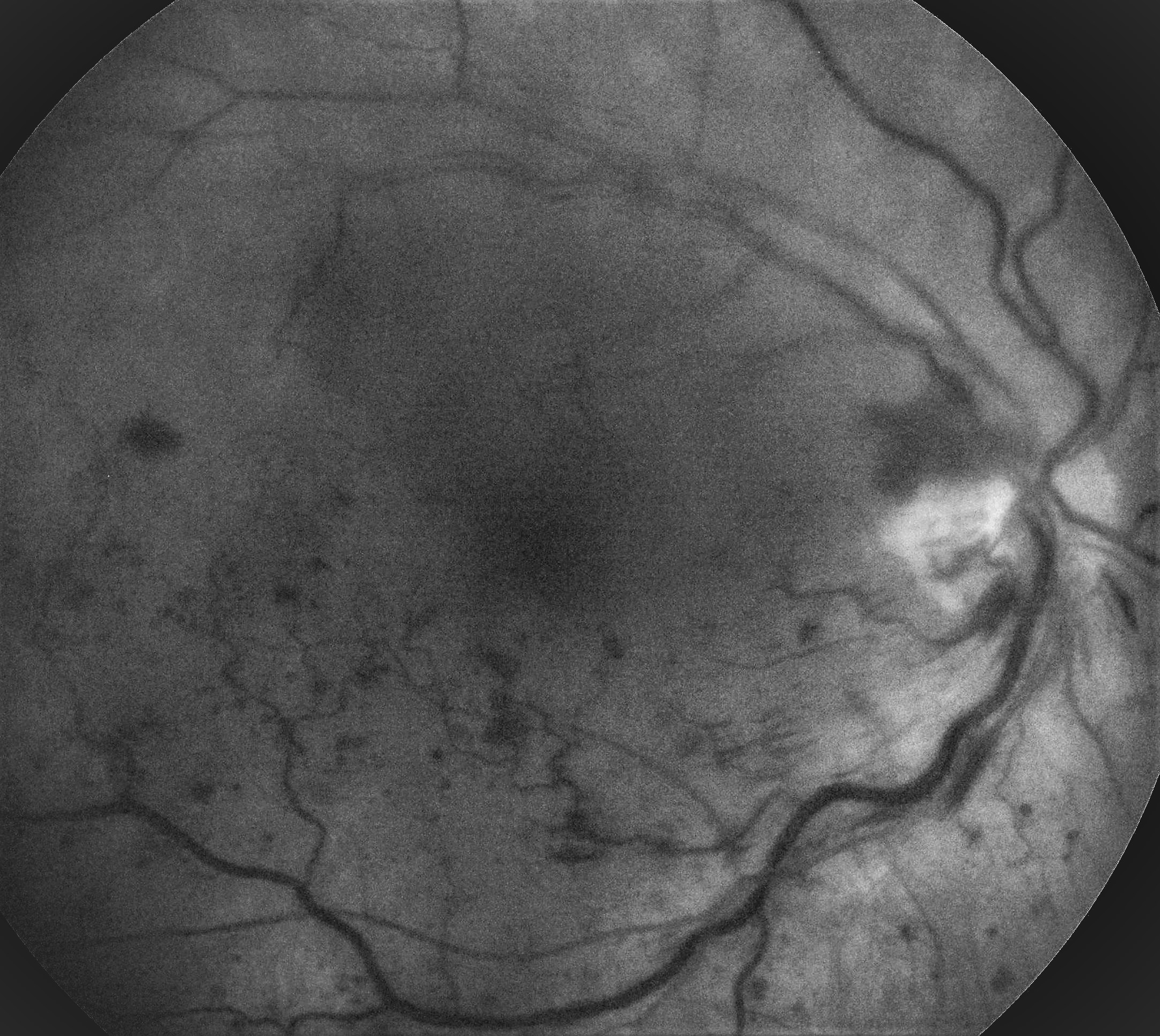 Der retinale Venenverschluss (RVV) - GermanEyeCare Der retinale Venenverschluss (RVV) - GermanEyeCare